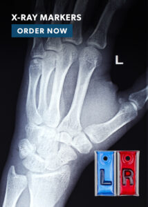 What is an X-ray marker? Exploring Its Purpose and Use in Radiography ...